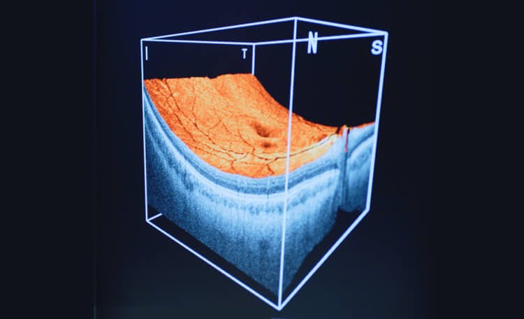 Oct Eye Scan Benjamin Opticians